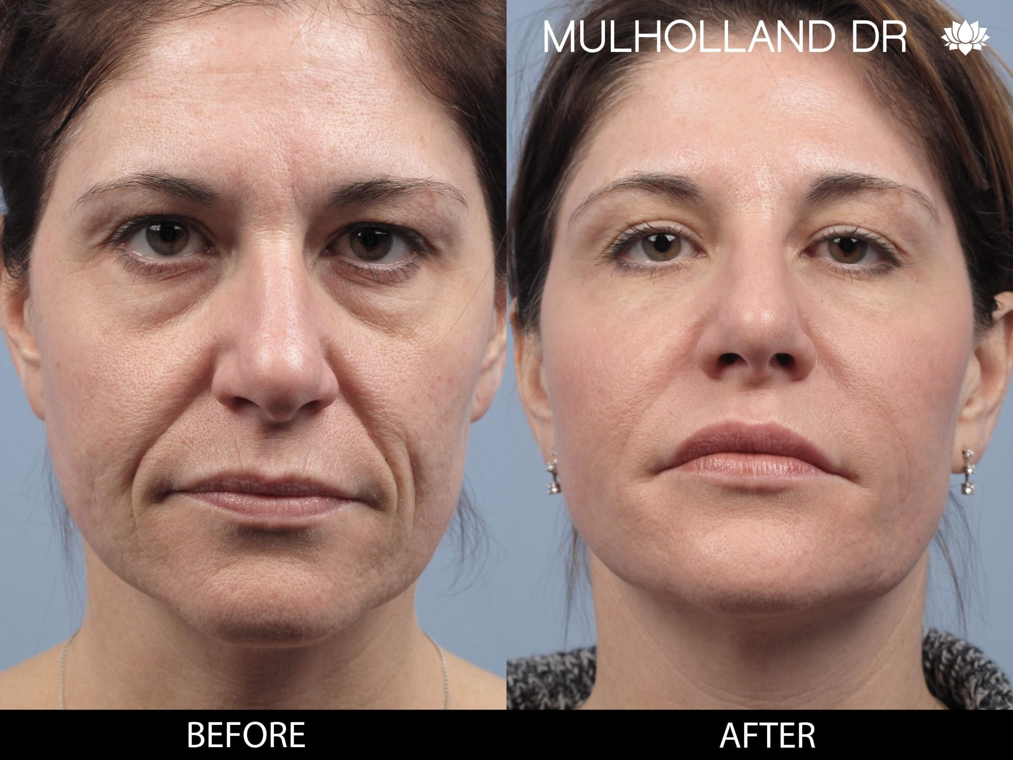 Juvederm Injectable Toronto - See Juvederm Before & Afters!