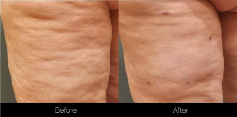 Cellulite Reduction Treatment in Toronto | SpaMedica