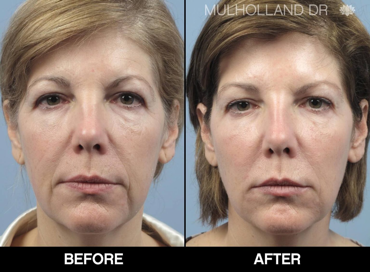 Fractional CO2 Laser in Toronto | Laser Skin Resurfacing