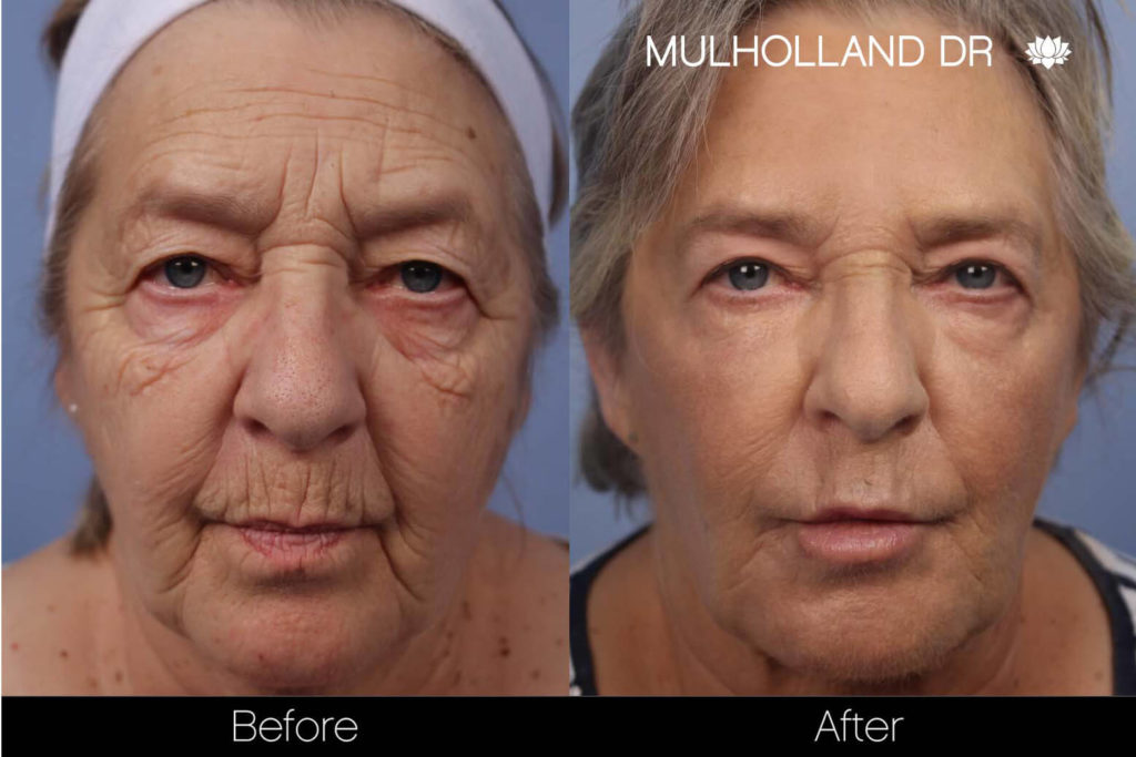 Morpheus8 Procedure in Toronto | SpaMedica