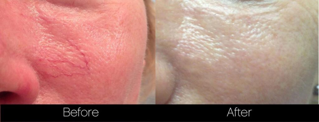 Laser Rosacea Treatment in Toronto | SpaMedica