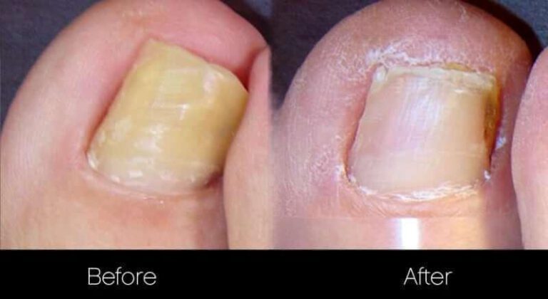 Laser Toe Fungus Removal in Toronto | SpaMedica