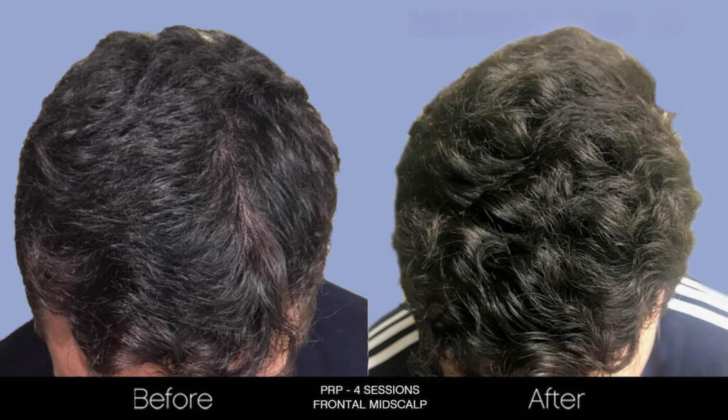 Non-Surgical Hair Restoration Before & After Gallery | SpaMedica Non-Surgical Hair Restoration Before & After Gallery | SpaMedica