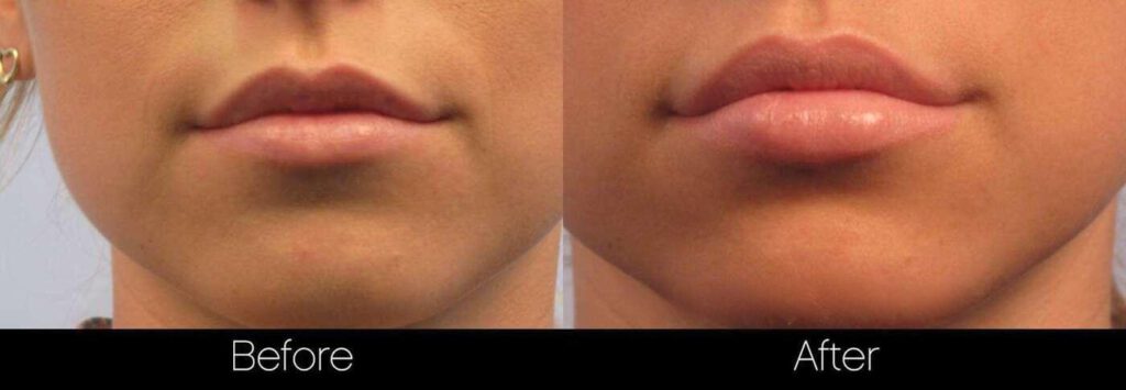 Best Lip Injections Toronto | Lip Augmentation at SpaMedica