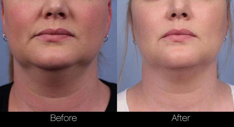 Belkyra Injection Before & After Gallery | SpaMedica