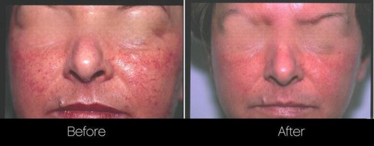 Laser Rosacea Treatment in Toronto | SpaMedica