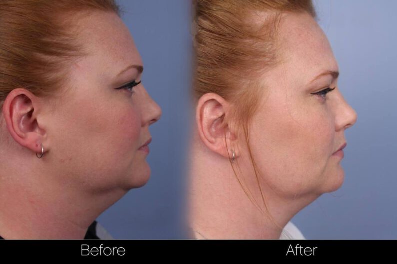 Belkyra Injection Before & After Gallery | SpaMedica