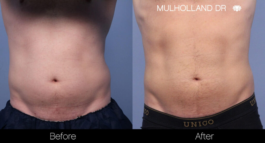 Sculpsure Laser Fat Removal Toronto - See Our Before & Afters!