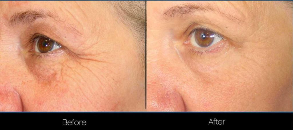 Best Laser Skin Resurfacing (Wrinkle Removal) in Toronto
