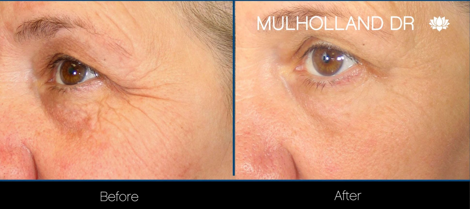 Fractora Facial Treatment in Toronto | SpaMedica