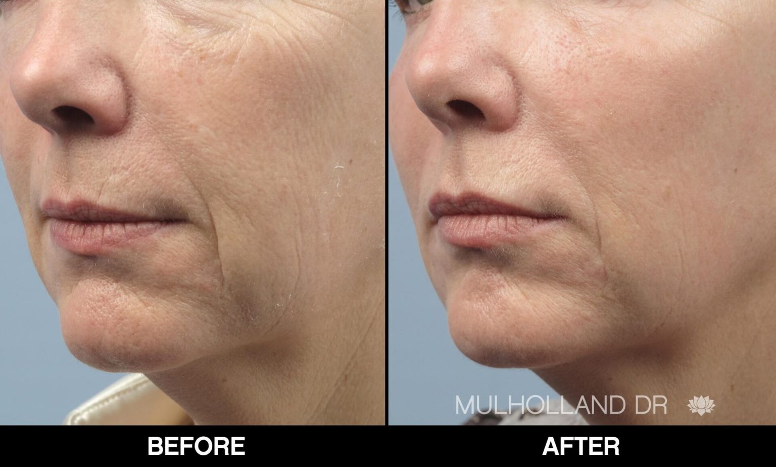 Fractora Facial Treatment in Toronto | SpaMedica