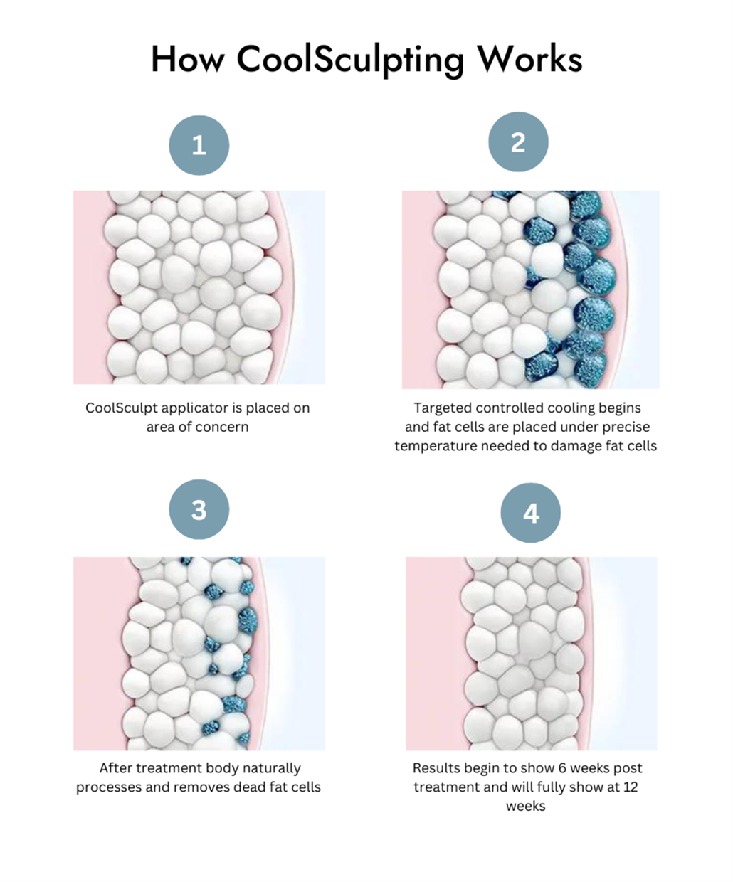 Pros & Cons of Non-Surgical Fat Removal: Heating Vs. Cooling
