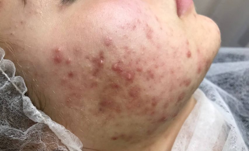 The Complete Guide to Comedones | SpaMedica