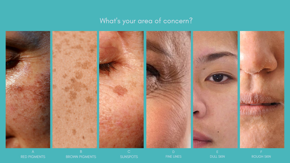 Safe and Sound with SpaMedica: Choose the Right Laser Treatment for ...