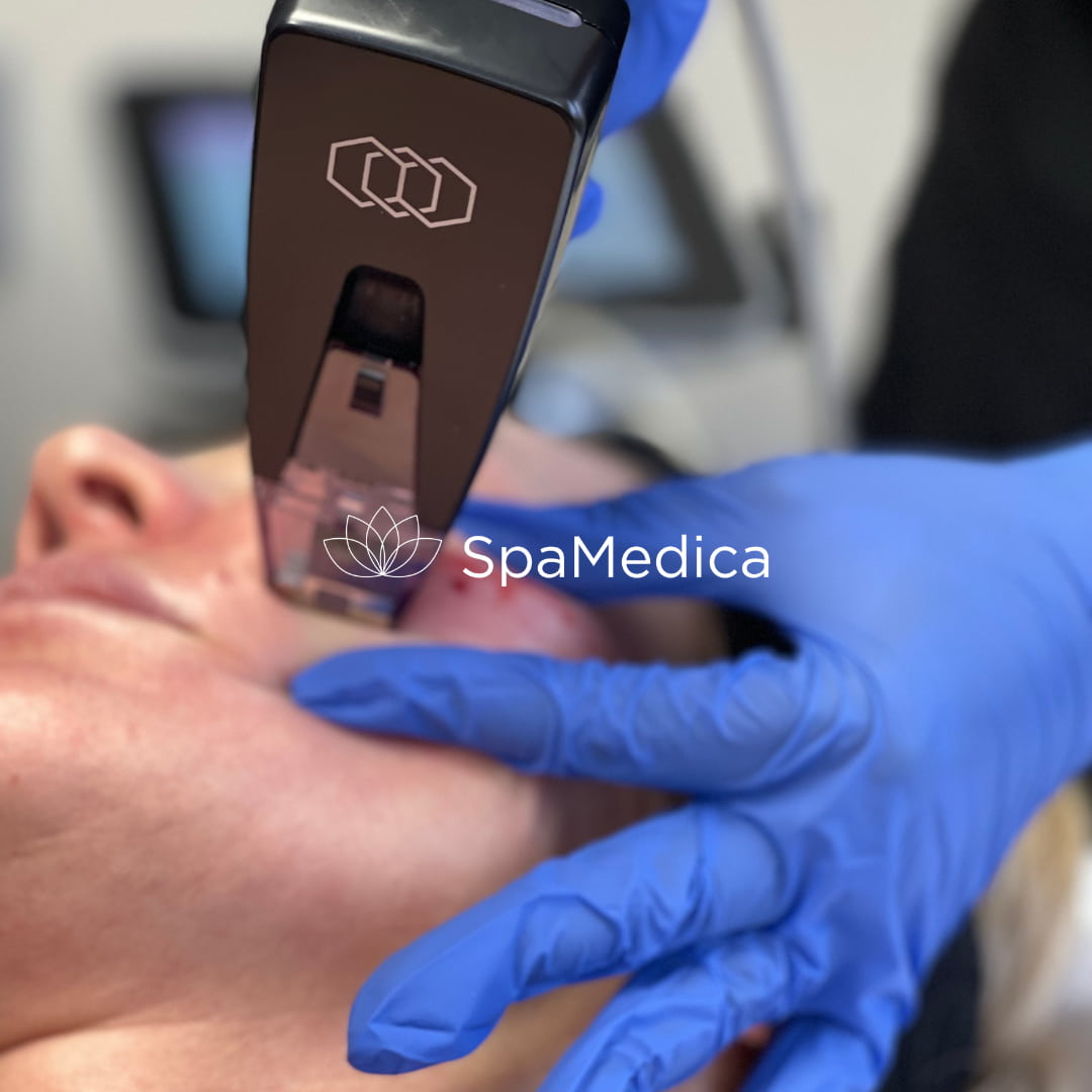 The Before and After of Morpheus8 Skin Tightening: SpaMedica’s Guide ...