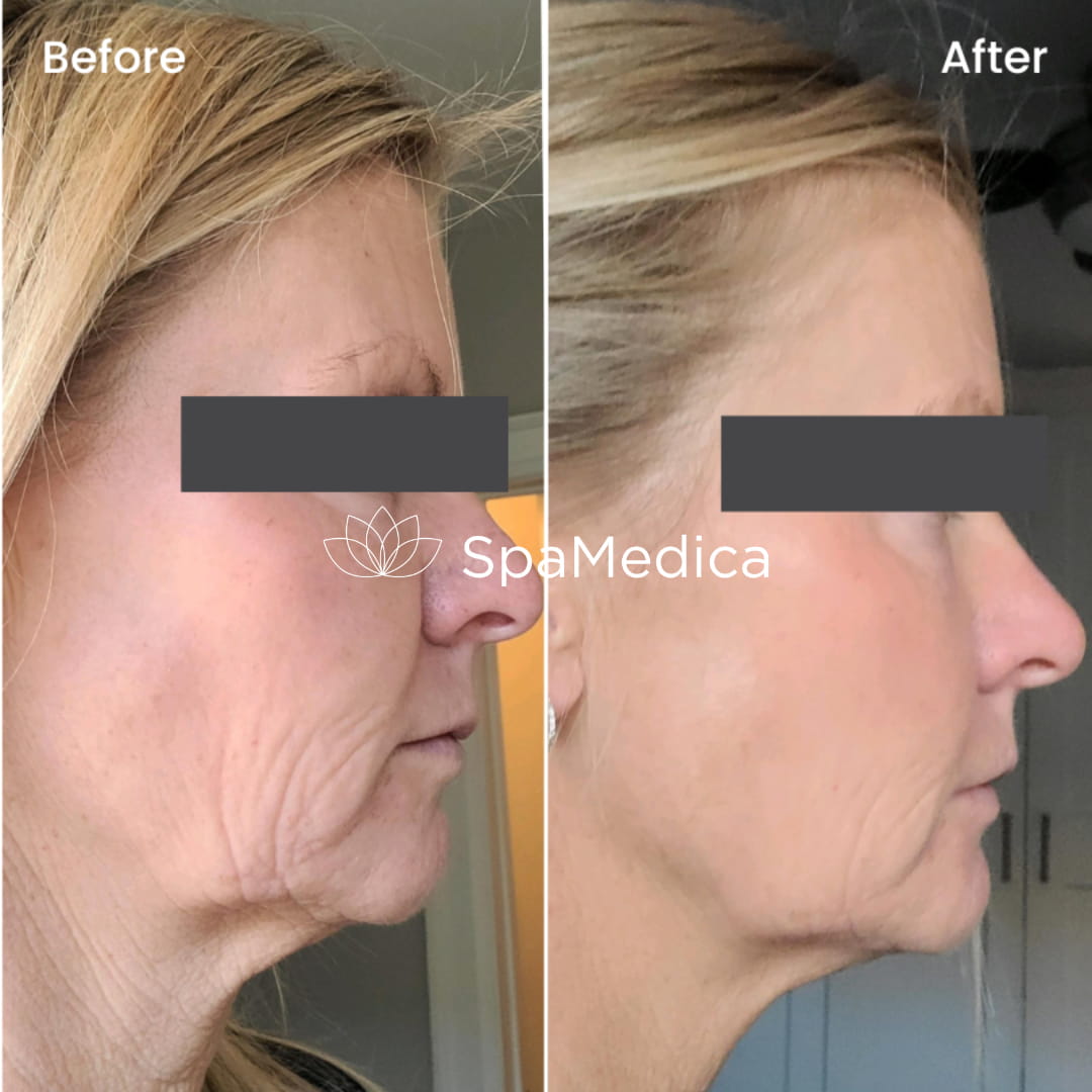 The Before and After of Morpheus8 Skin Tightening: SpaMedica’s Guide ...
