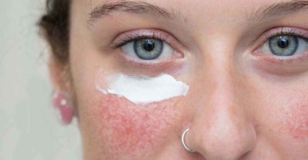 The Complete Guide to Understanding and Treating Blotchy Skin