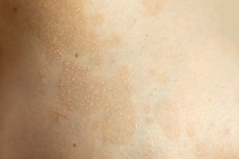 The Complete Guide to Understanding and Treating Blotchy Skin