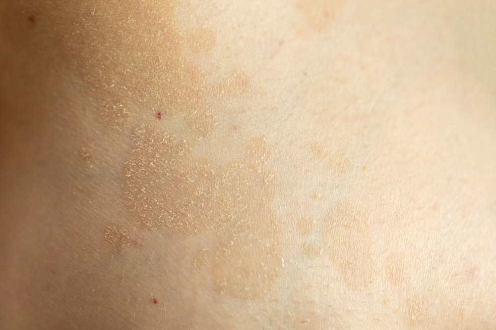 The Complete Guide to Understanding and Treating Blotchy Skin