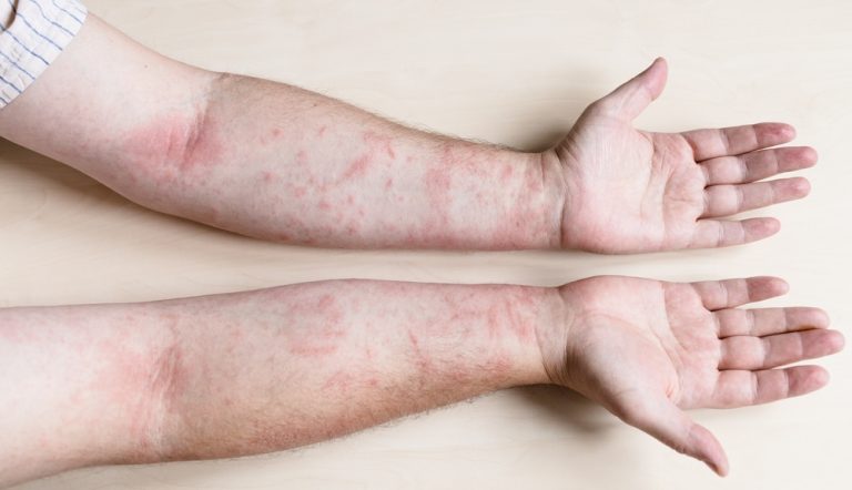 The Complete Guide to Understanding and Treating Blotchy Skin
