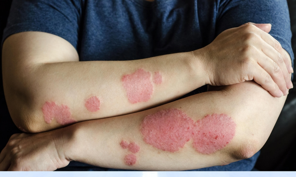 The Complete Guide to Understanding and Treating Blotchy Skin