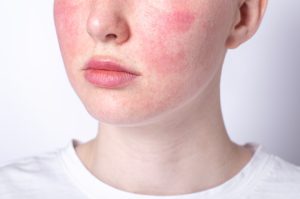 The Complete Guide to Understanding and Treating Blotchy Skin
